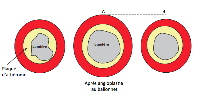 Quelques définitions - Cardio paramed : Cardio paramed