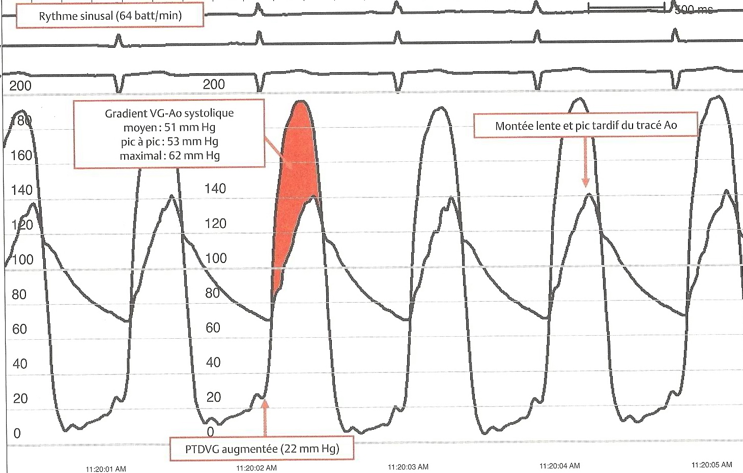 La ventriculographie gauche - Cardio paramed : Cardio paramed