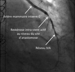 Koronare In-Stent-Restenose: Prädiktoren Und Therapie – MHIM