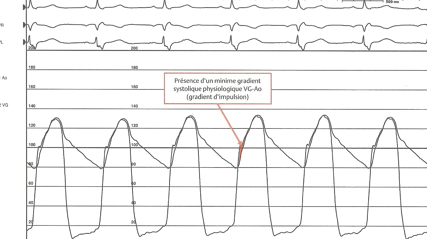 La ventriculographie gauche - Cardio paramed : Cardio paramed